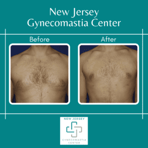 Things to Know About Gynecomastia Grades & Stages
