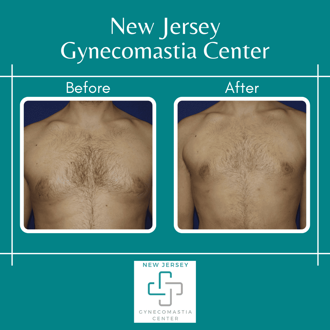 Things to Know About Gynecomastia Grades & Stages