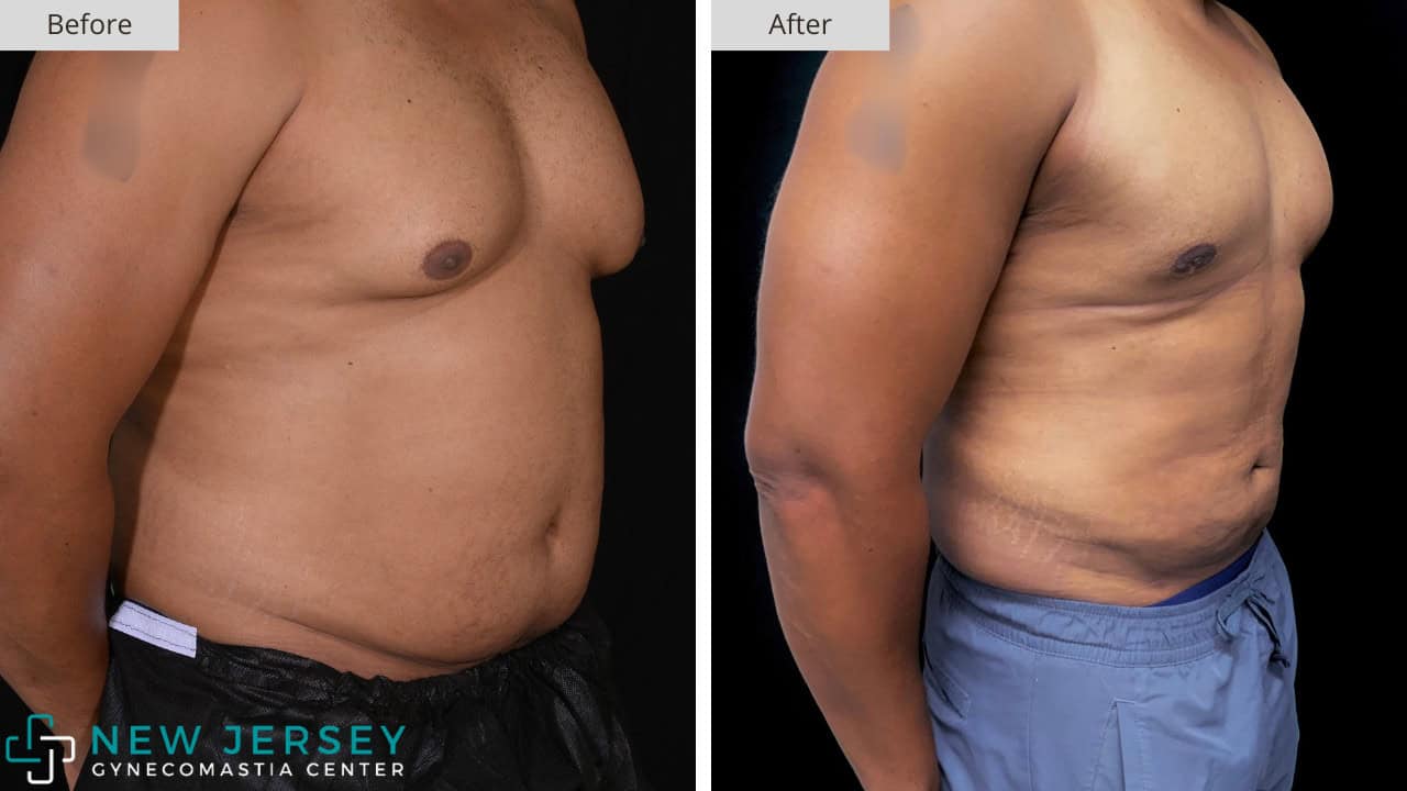 10 Questions to Ask Before Gynecomastia Surgery in New Jersey