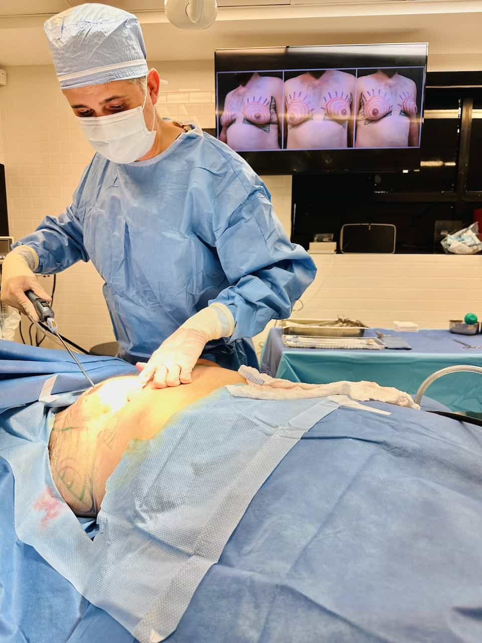 Gynecomastia Surgery Scars: What You Need to Know